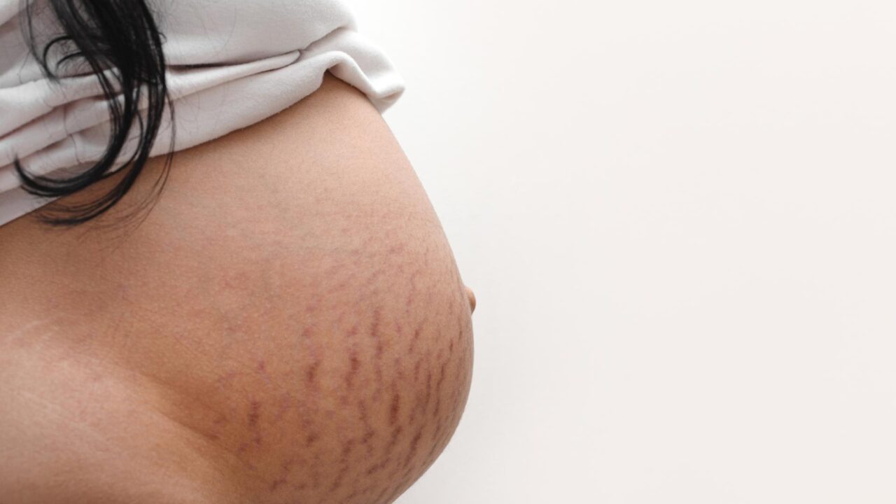 Prévenir varices, cellulite et vergetures en grossesse